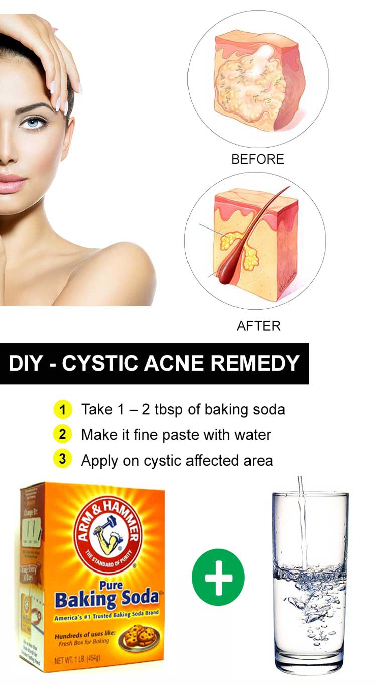 25 Cystic Acne Home Remedies That Really Work (Updated 2019)