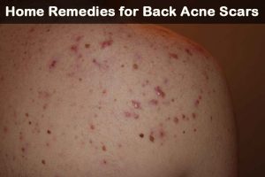 21 Effective Ways to Treat Back Acne Scars Naturally (2019 Revision)