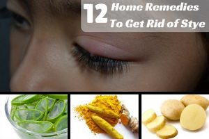 Top 12 Home Remedies to Get Rid of Stye