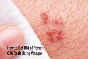 How to Get Rid of Poison Oak Rash Using Vinegar?